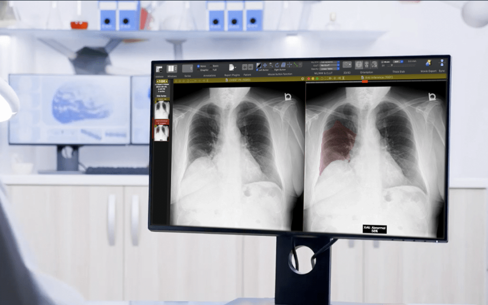 How AI is Helping Diagnose Lung Abnormalities | 1QBit